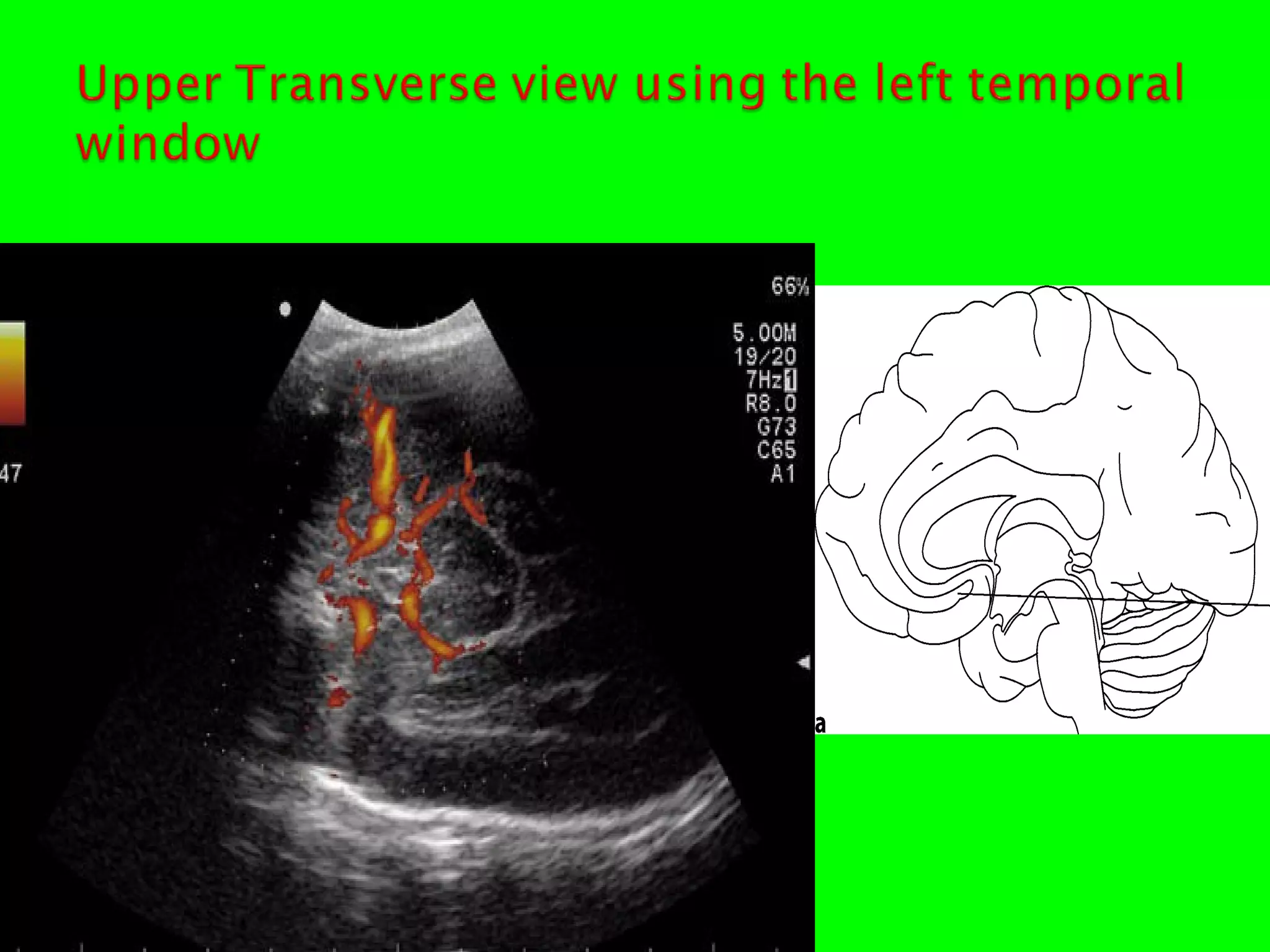 Neonatal ultrasound overview | PPT
