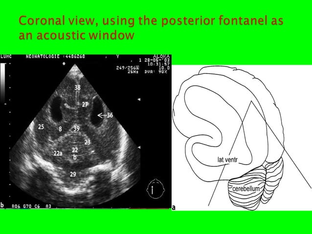 Neonatal ultrasound overview | PPT | Brain and Nervous System Disorders ...