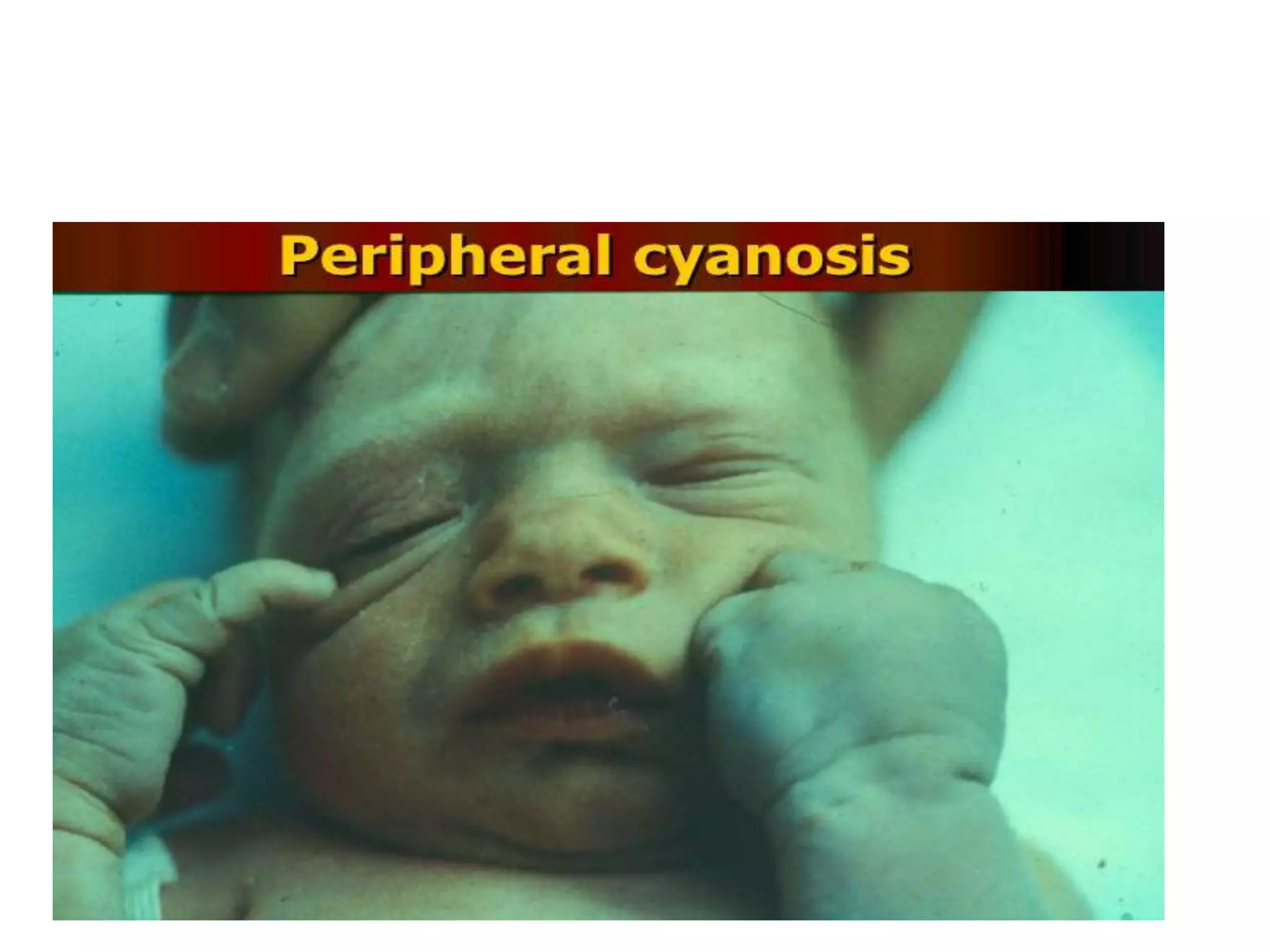 Neonatal warning signs | PPTX