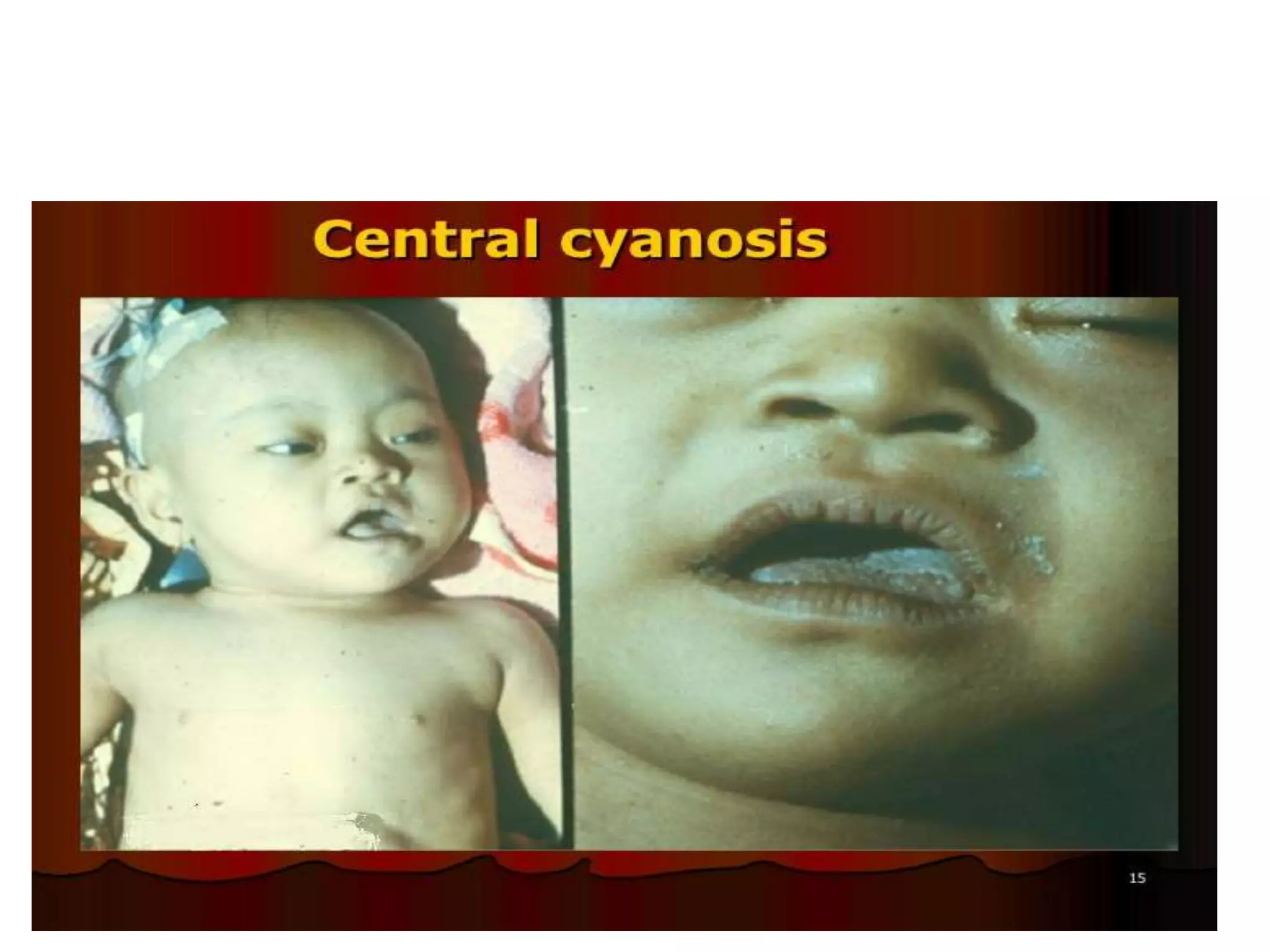 Neonatal warning signs | PPTX