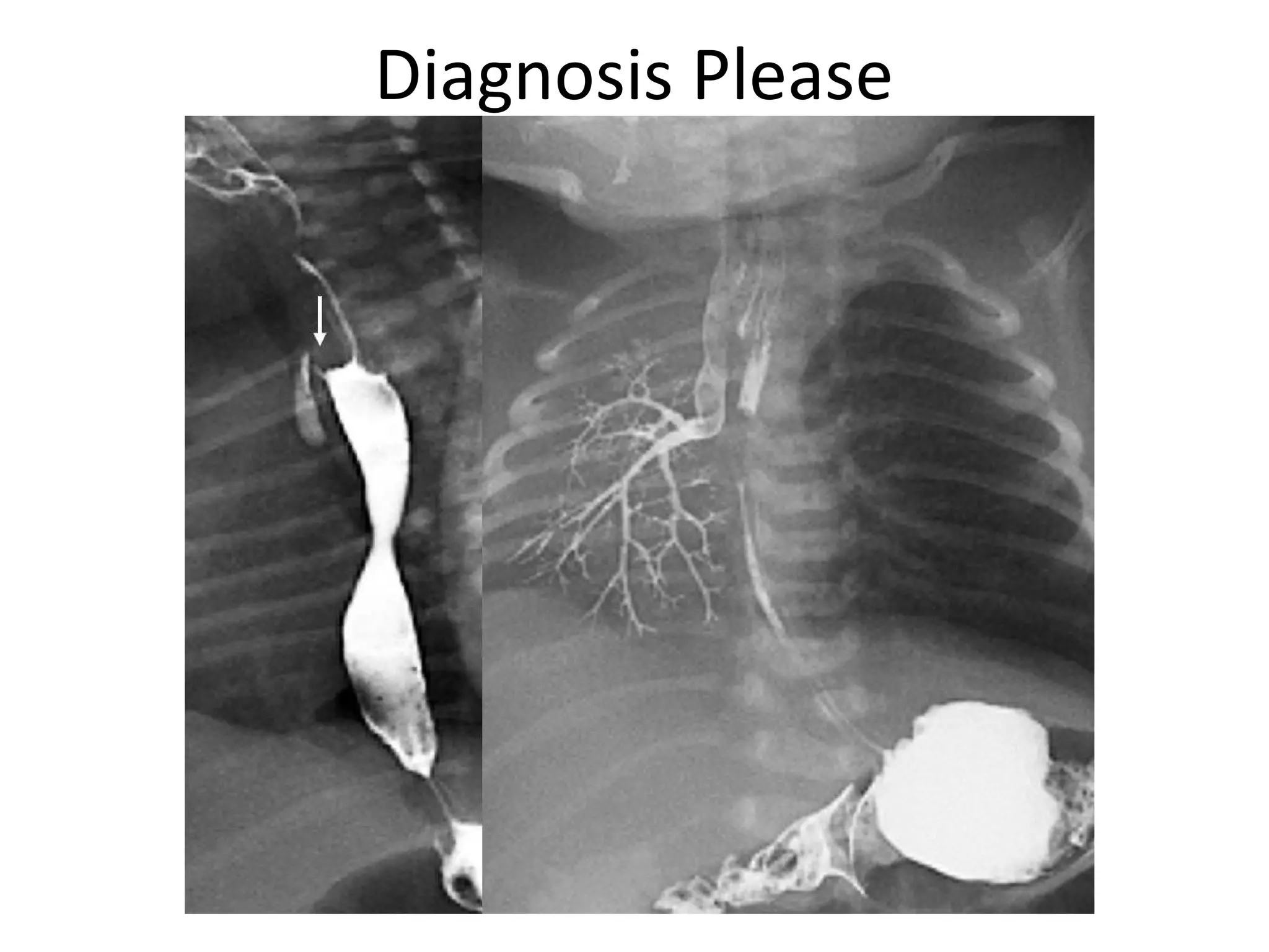 Neonatal xray & spots git | PPT