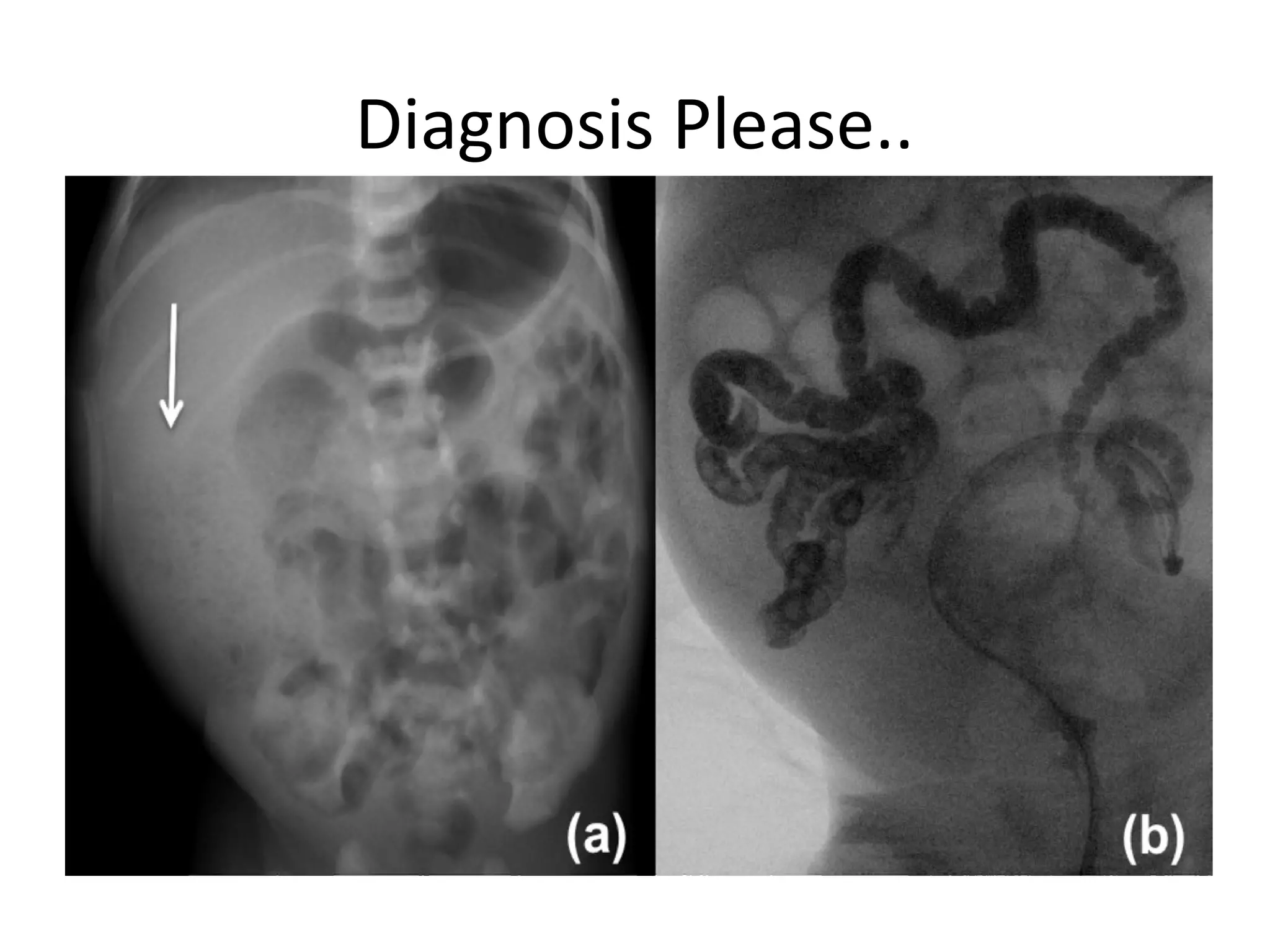 Neonatal xray & spots git | PPT