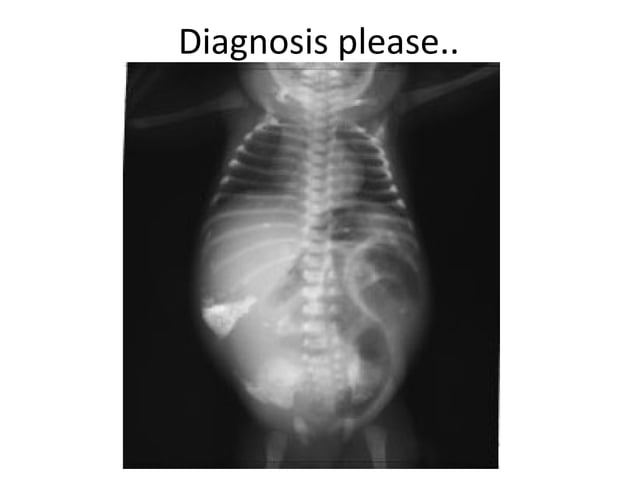 Neonatal xray & spots git | PPT