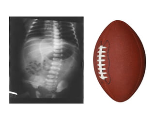 Image Neonatal Football Sign