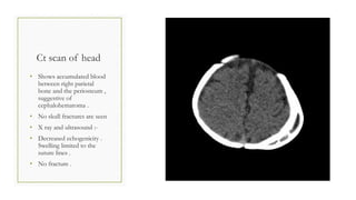 Neonate case history cephalohematoma.pdf