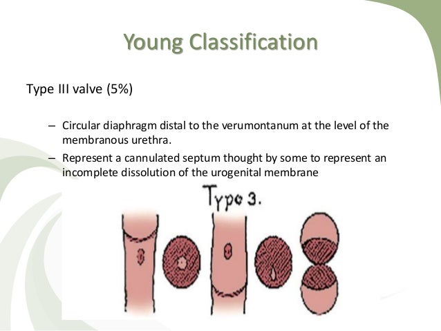 obstructive uropathy in Neonatology