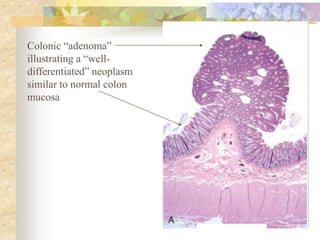 Neoplasia 1 basic | PPTX