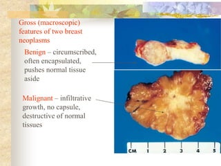 Neoplasia 1 basic | PPTX