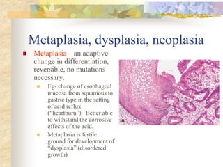 Neoplasia 1 basic | PPTX