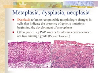 Neoplasia 1 basic | PPTX