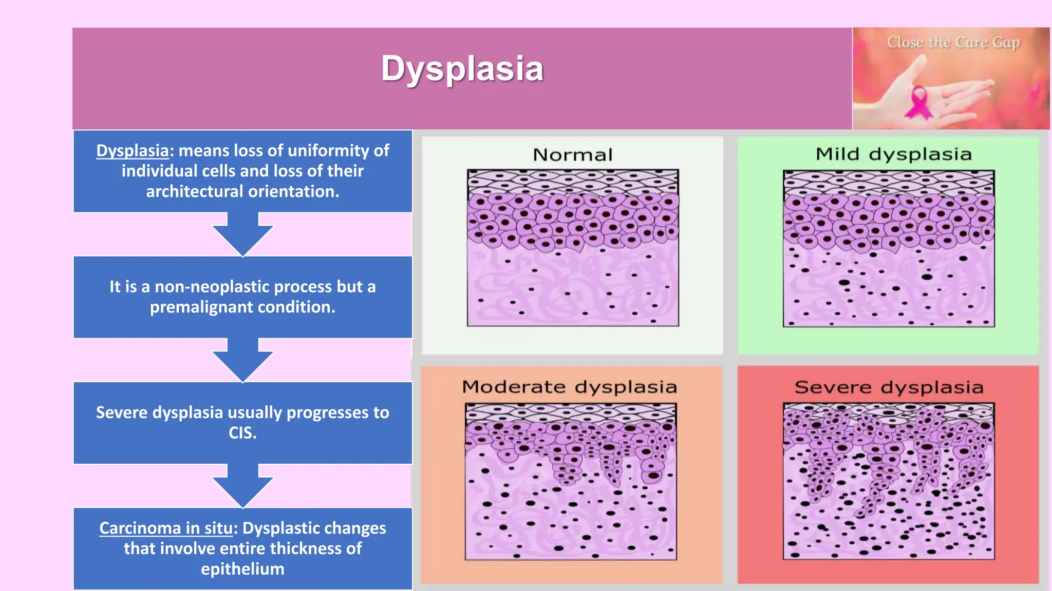 ANNOTATION ON THE BASIC CONCEPT OF NEOPLASM..PPTX