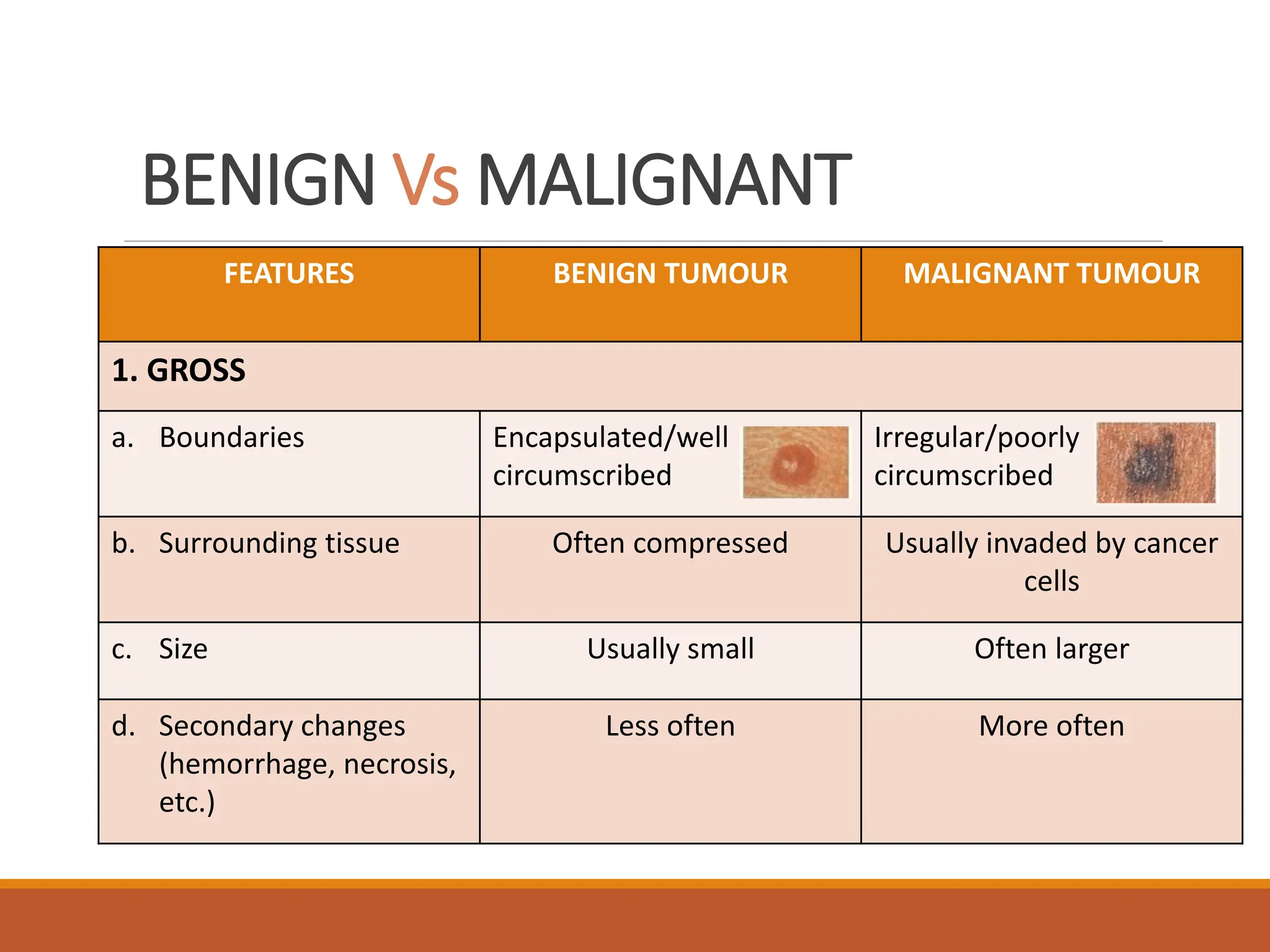NEOPLASIA, cancer, Benign and malignant tumor | PPTX