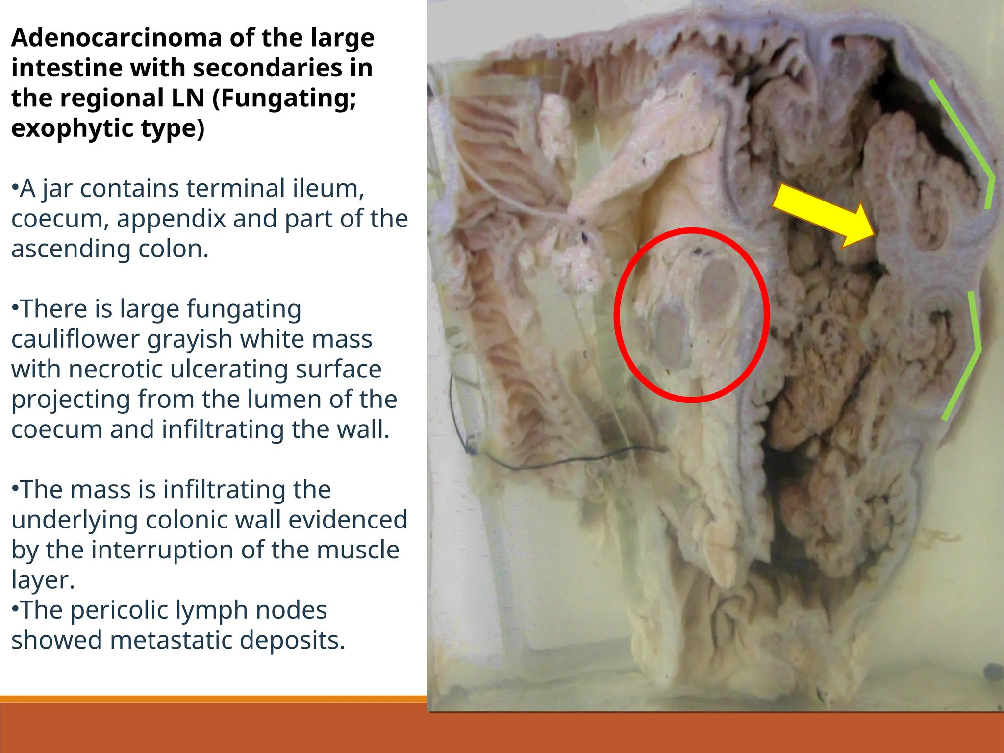 neoplasia and examples in different organs.ppt