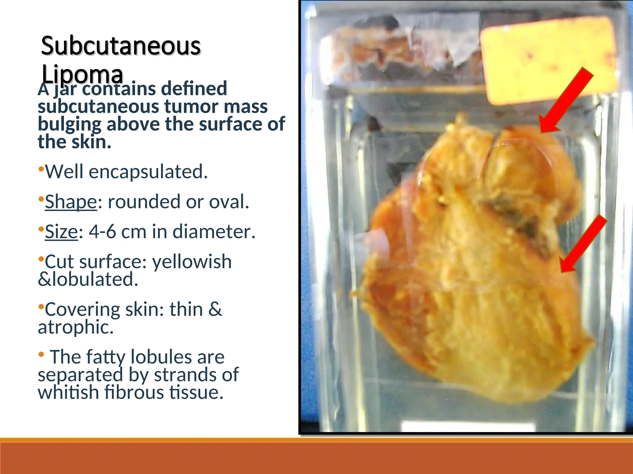neoplasia and examples in different organs.ppt