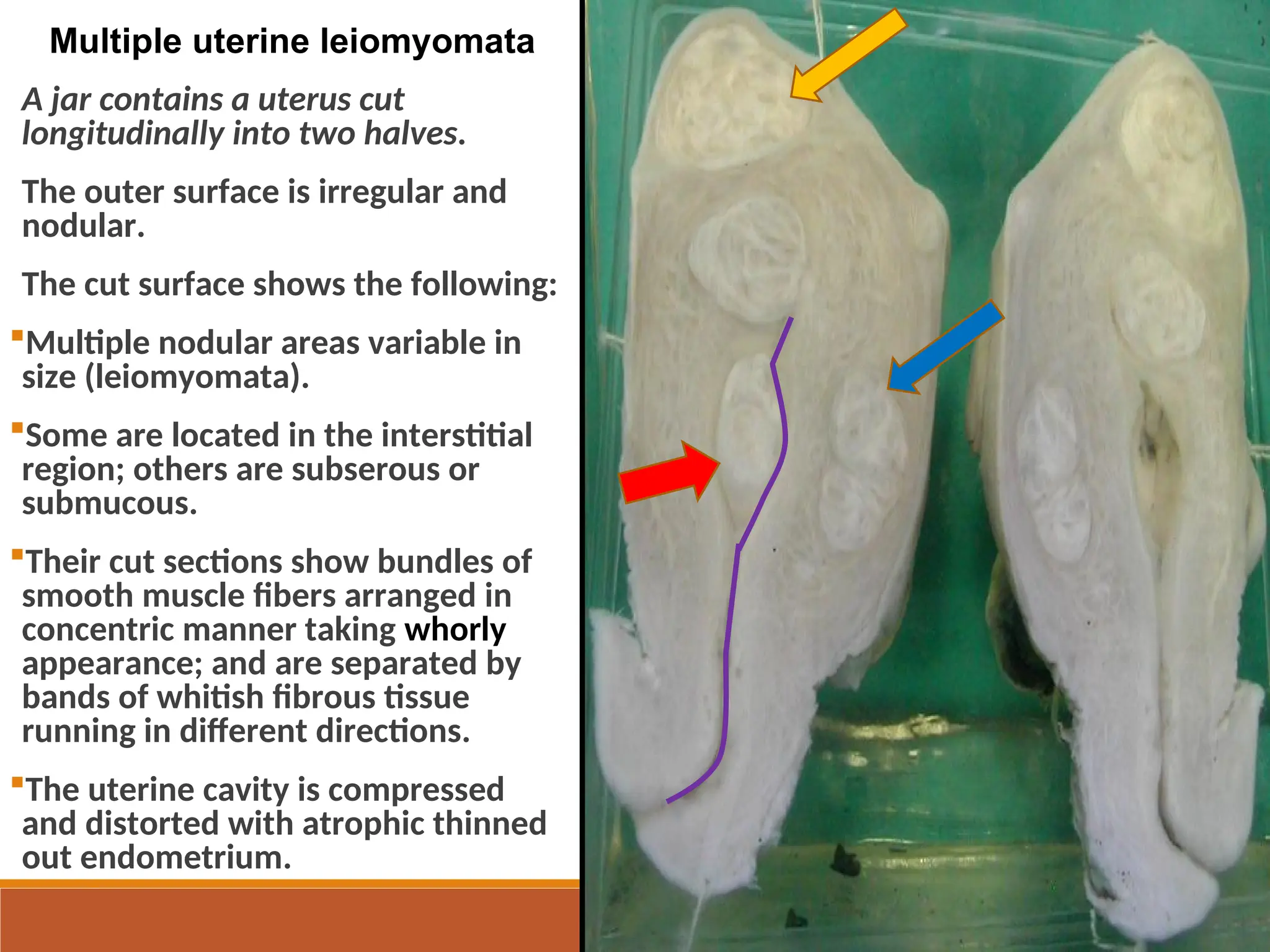 neoplasia and examples in different organs.ppt