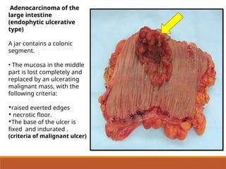 neoplasia and examples in different organs.ppt | Thyroid Disorders ...