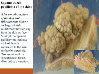 neoplasia and examples in different organs.ppt | Thyroid Disorders ...