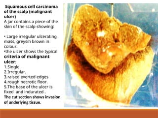 neoplasia and examples in different organs.ppt