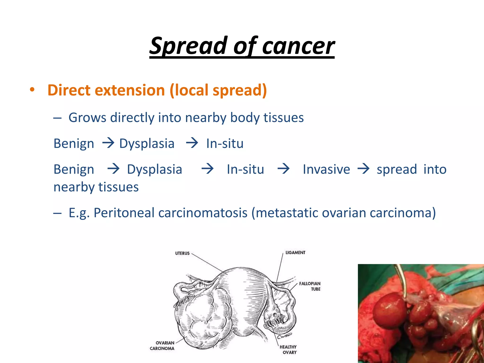 Neoplasia Clincial effects and Spread of cancer | PPTX