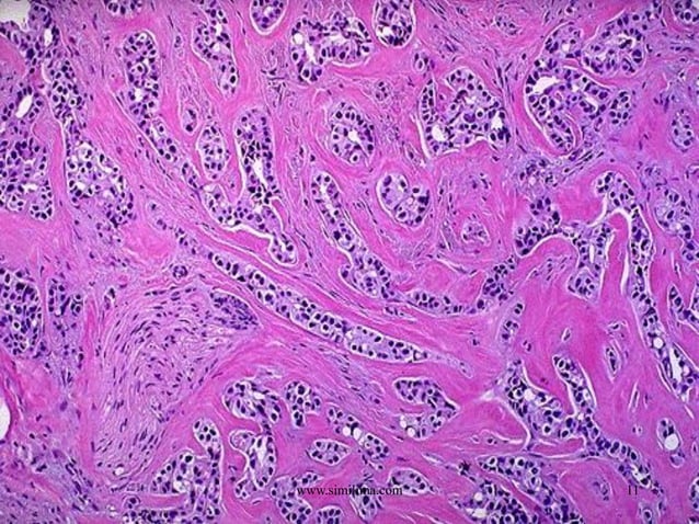 Chapter neoplasia-basics general pathology | PPT