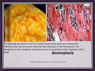 Neoplasia ospe rapid review | PPTX
