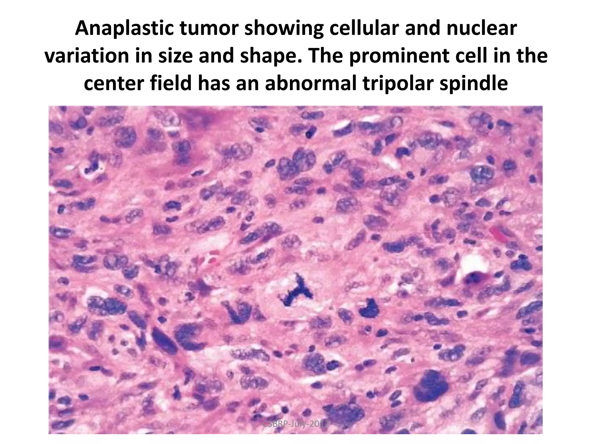 Neoplasia Robbin's path | PPTX