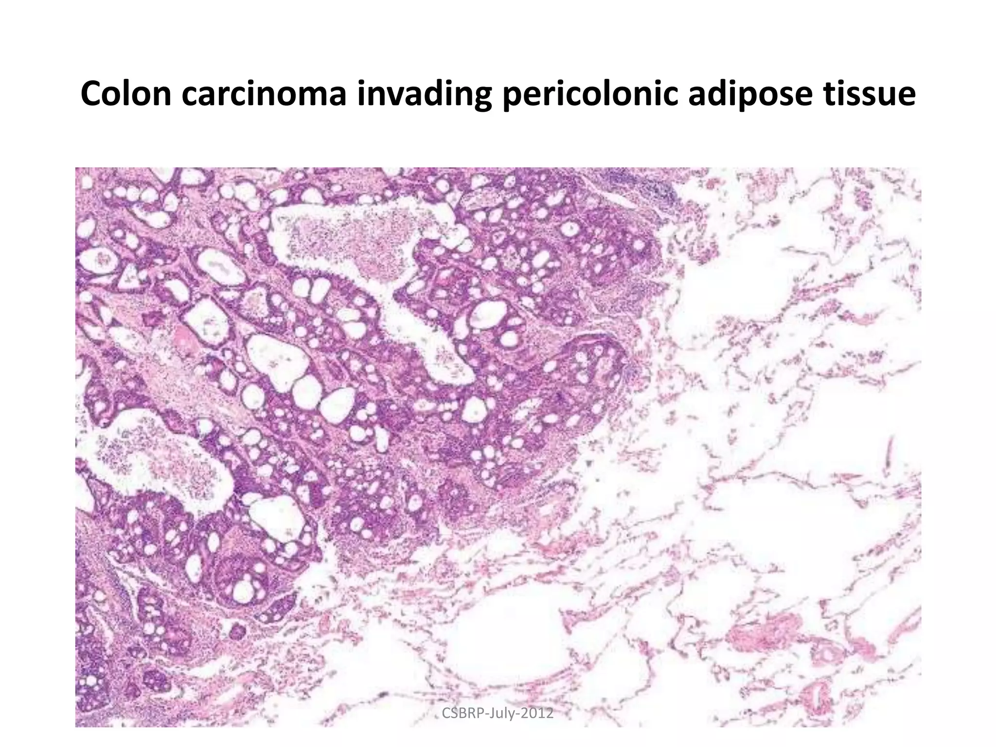 Neoplasia Robbin's path | PPTX
