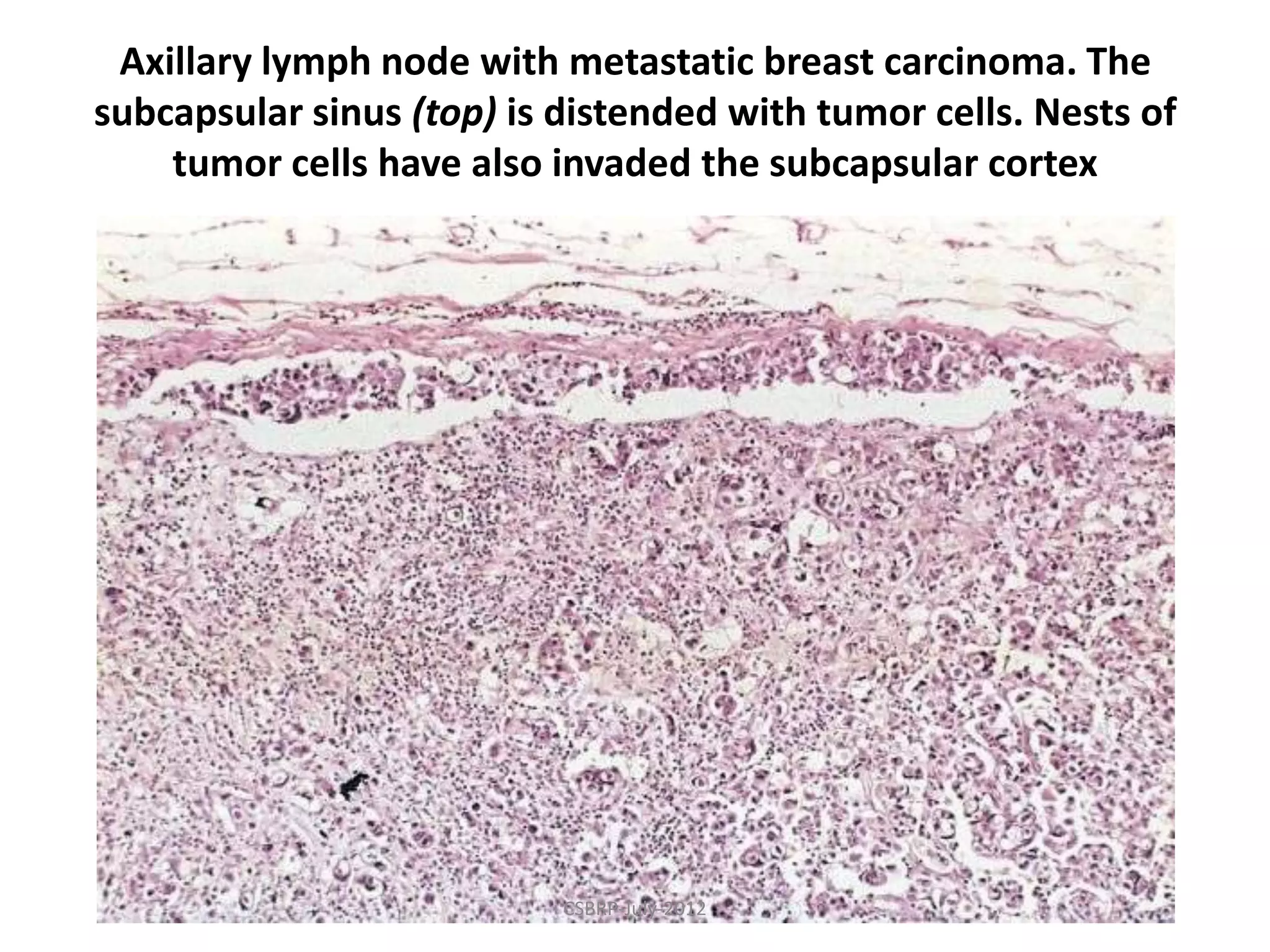 Neoplasia Robbin's path | PPTX