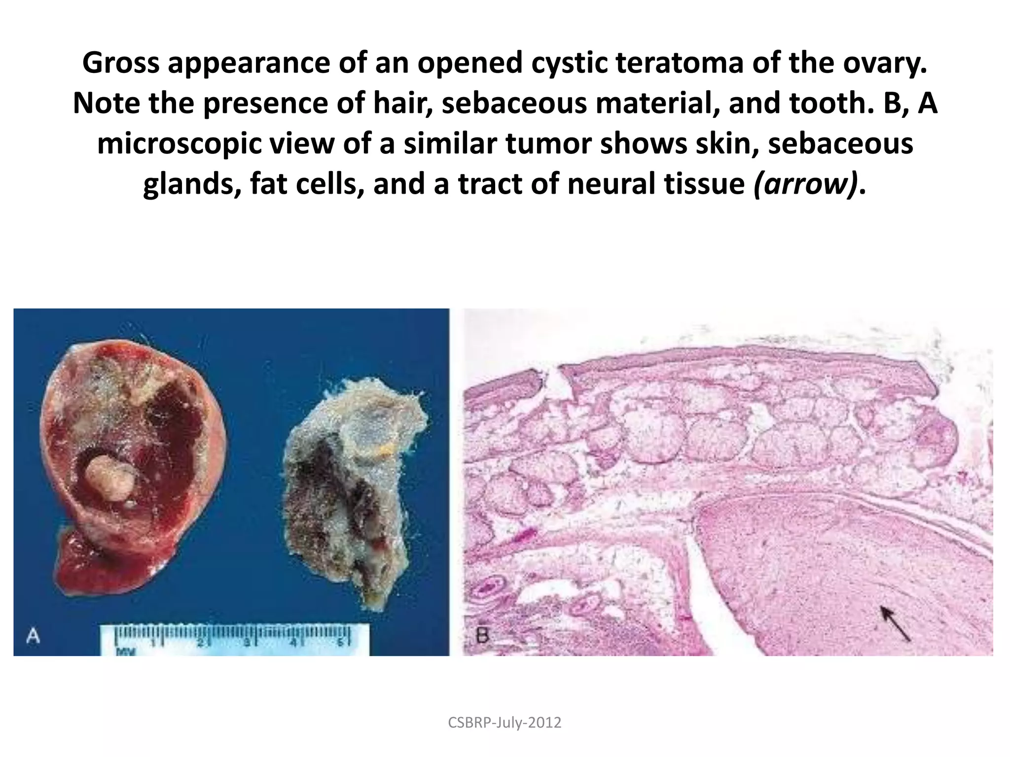 Neoplasia Robbin's path | PPTX