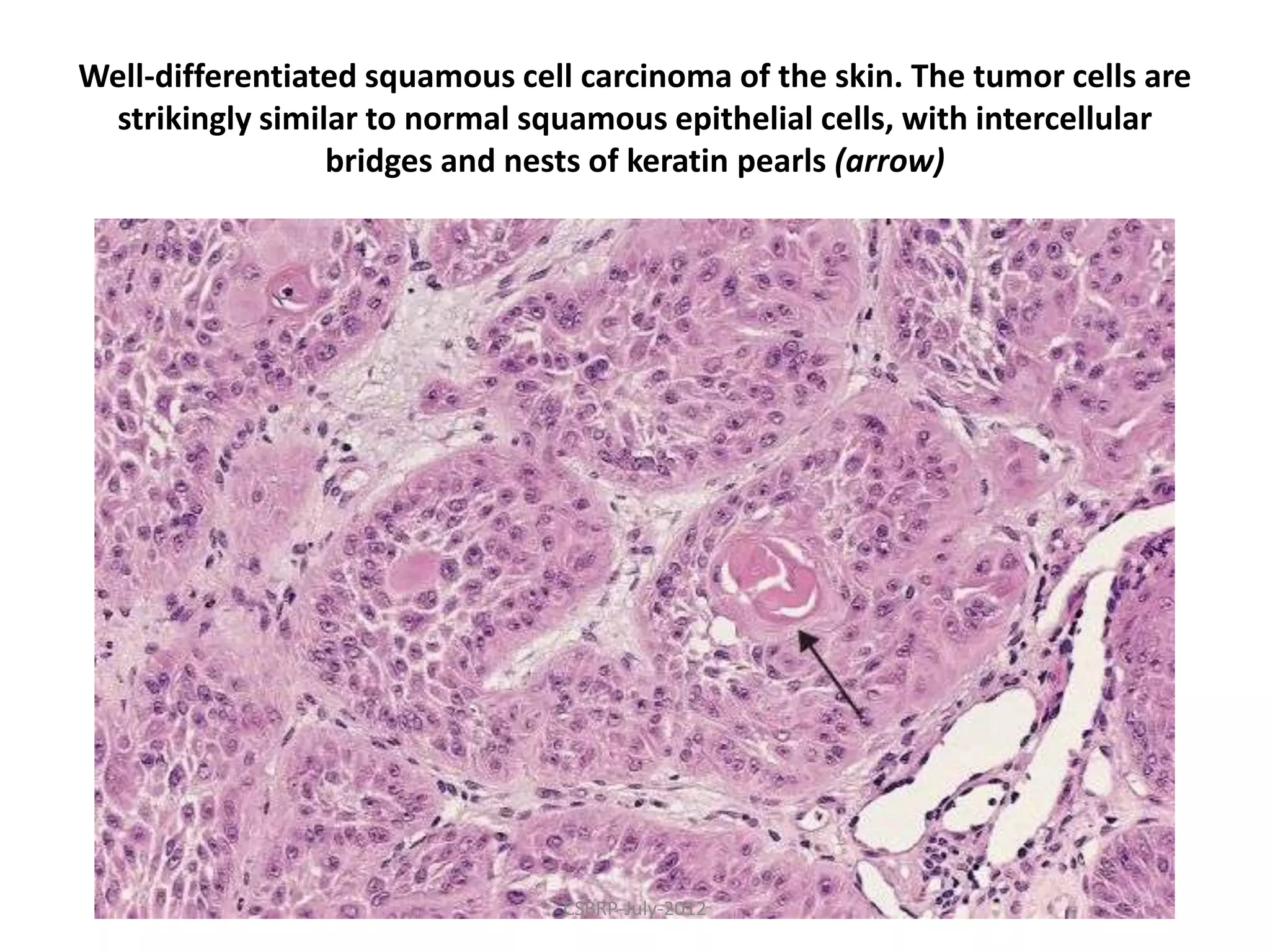 Neoplasia Robbin's path | PPTX