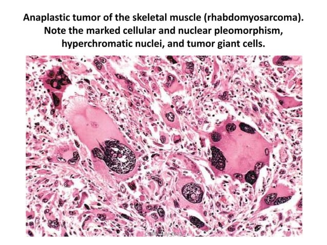 Neoplasia Robbin's path | PPTX