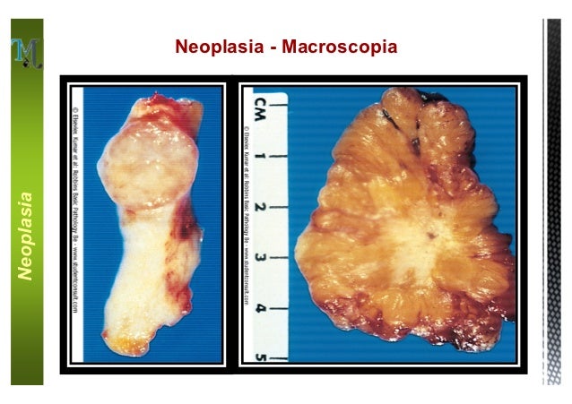 Neoplasia 1