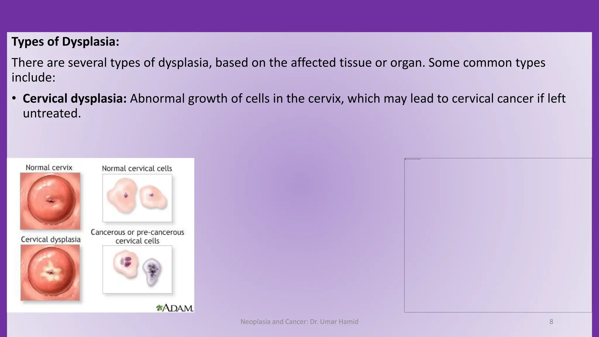 Neoplasia and Dysplasia.pptx