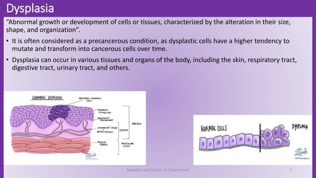 Neoplasia and Dysplasia.pptx