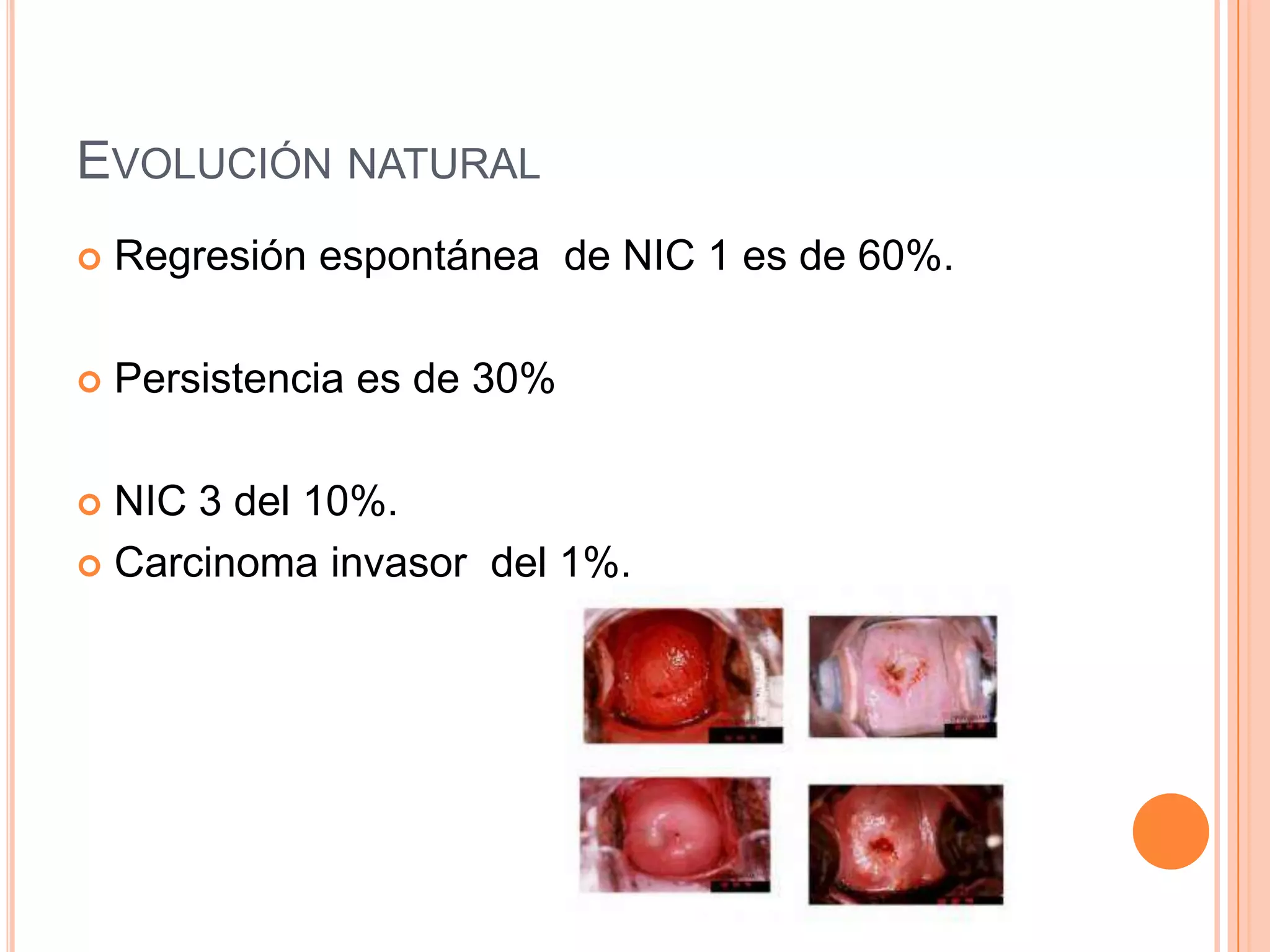 Neoplasia intraepitelial cervical (leibg y leiag) | PPTX