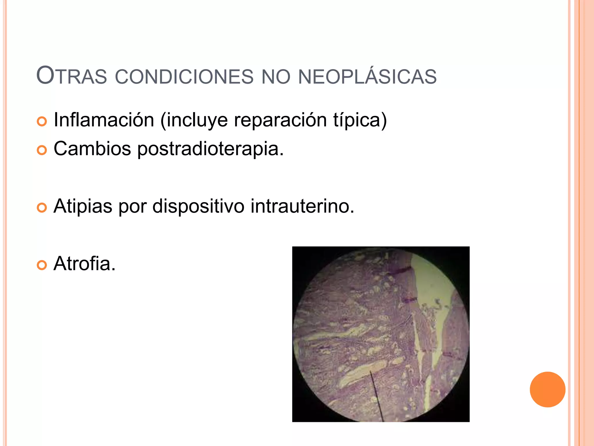 Neoplasia intraepitelial cervical (leibg y leiag) | PPTX