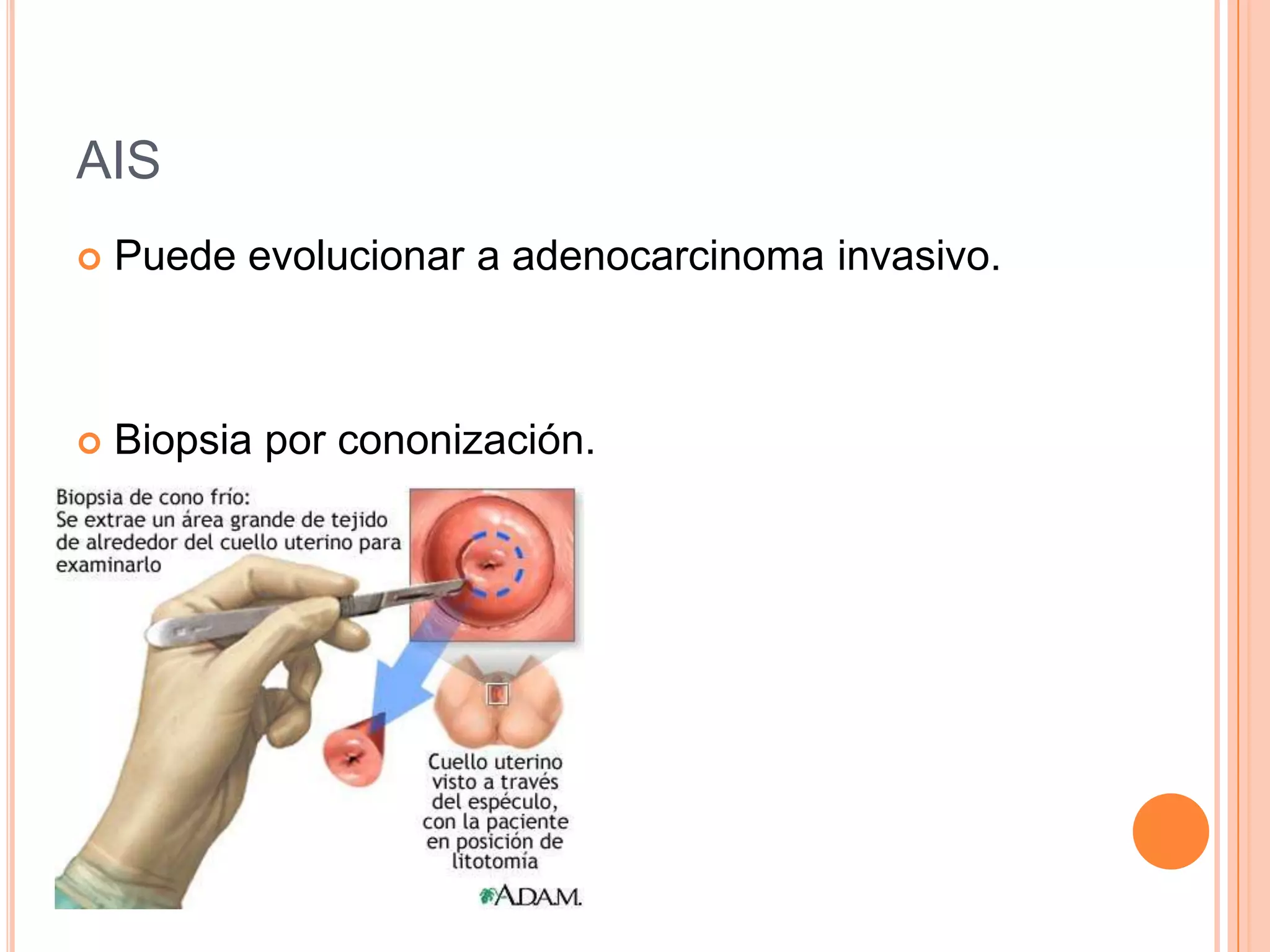 Neoplasia intraepitelial cervical (leibg y leiag) | PPTX