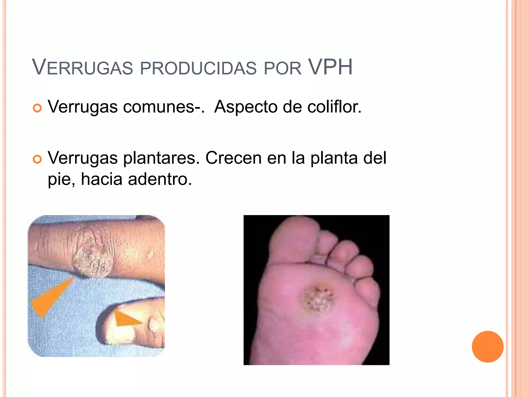 Neoplasia intraepitelial cervical (leibg y leiag) | PPTX