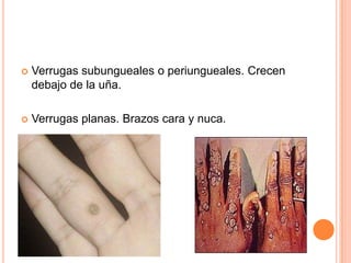 Neoplasia intraepitelial cervical (leibg y leiag) | PPTX