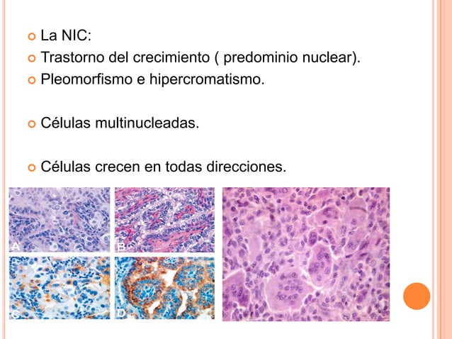 Neoplasia intraepitelial cervical (leibg y leiag) | PPTX