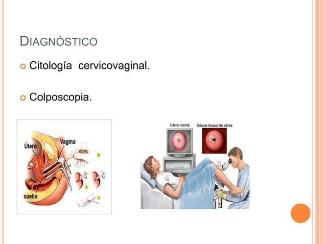 Neoplasia intraepitelial cervical (leibg y leiag) | PPTX