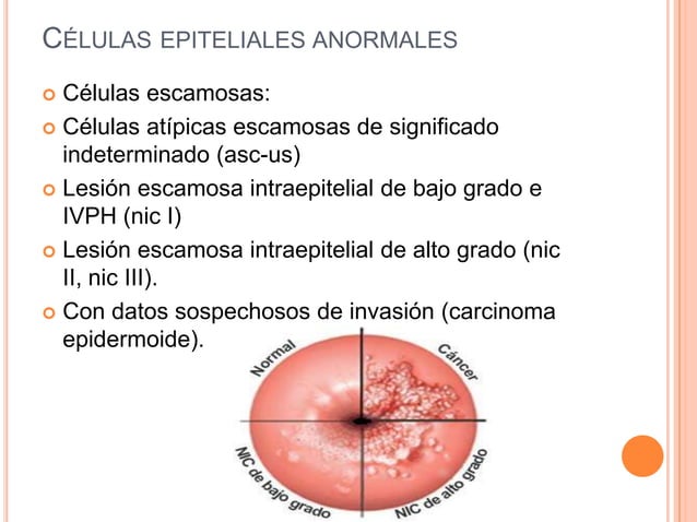 Neoplasia intraepitelial cervical (leibg y leiag) | PPTX