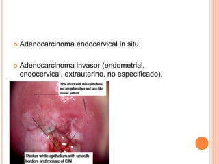 Neoplasia intraepitelial cervical (leibg y leiag) | PPTX