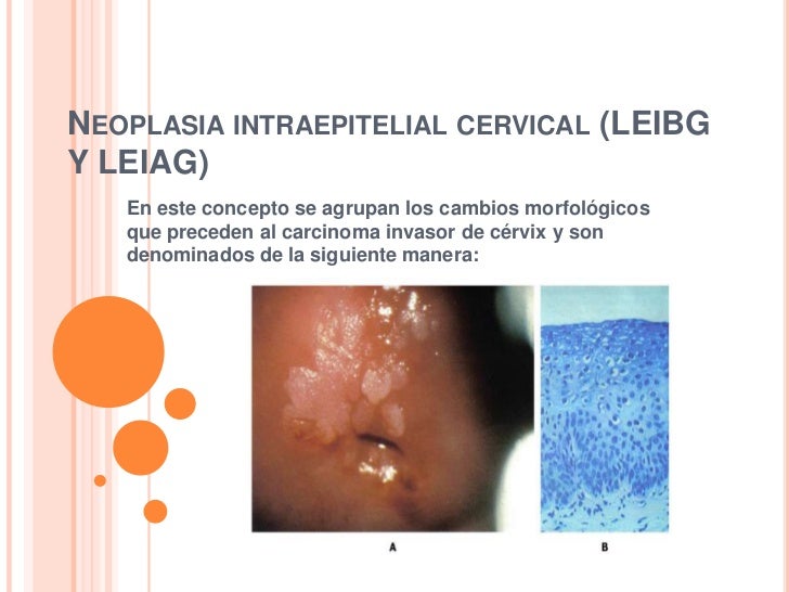 Neoplasia intraepitelial cervical (leibg y leiag)