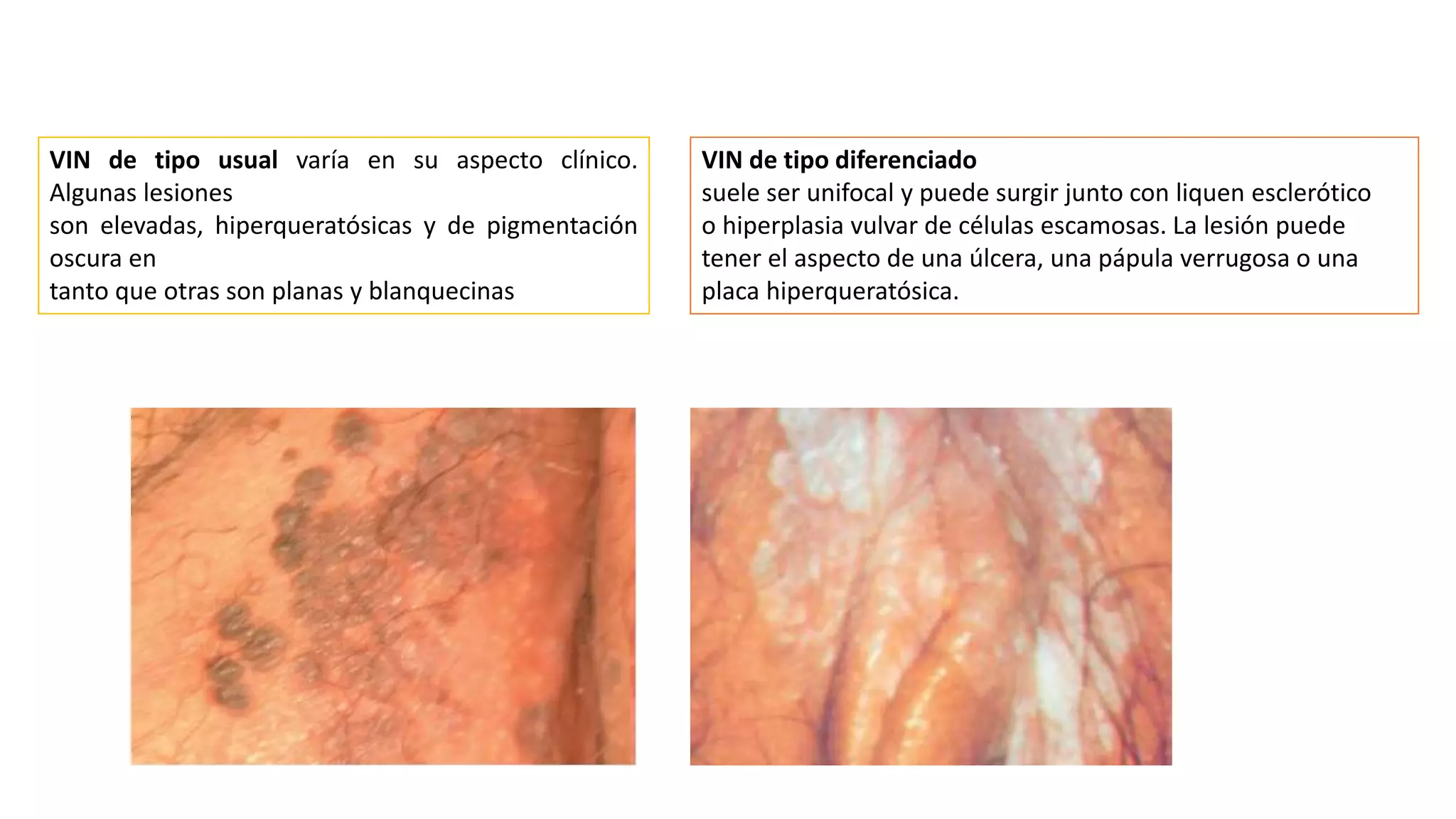 Neoplasia Intraepitelial Vulvar Ppt