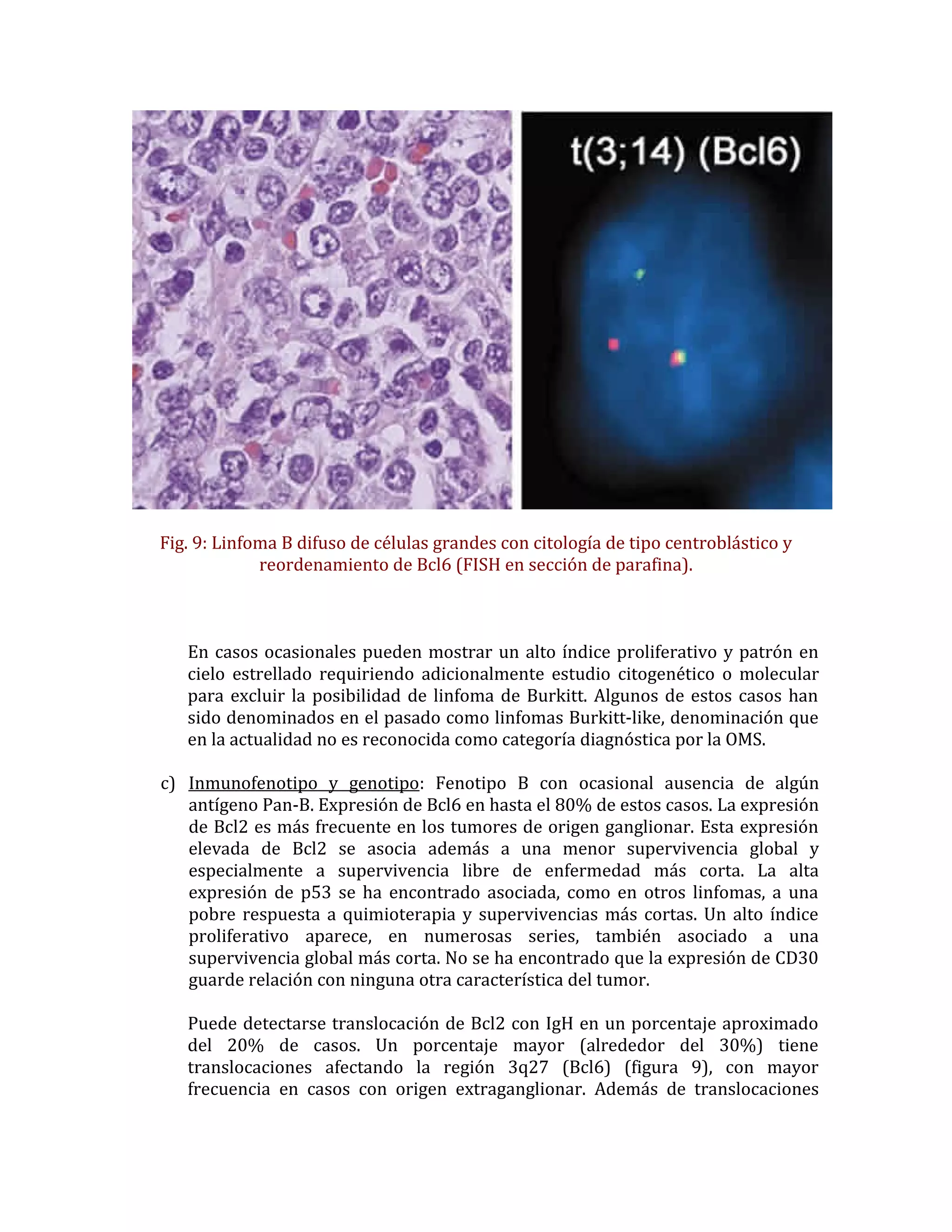 Neoplasias de células b maduras | DOC