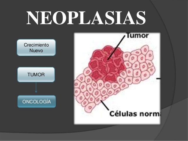 Neoplasias - Anatomía Patológica