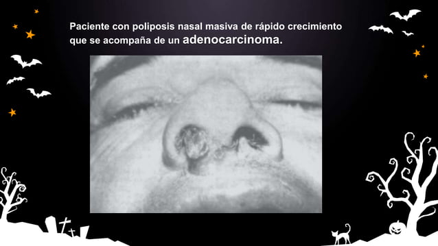Tumores malignos de nariz y senos paranasales