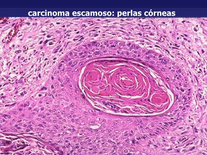 Neoplasias malignas 1