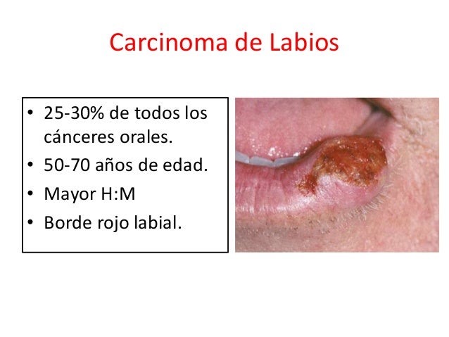 Neoplasias malignas de origen epitelial de la cavidad oral